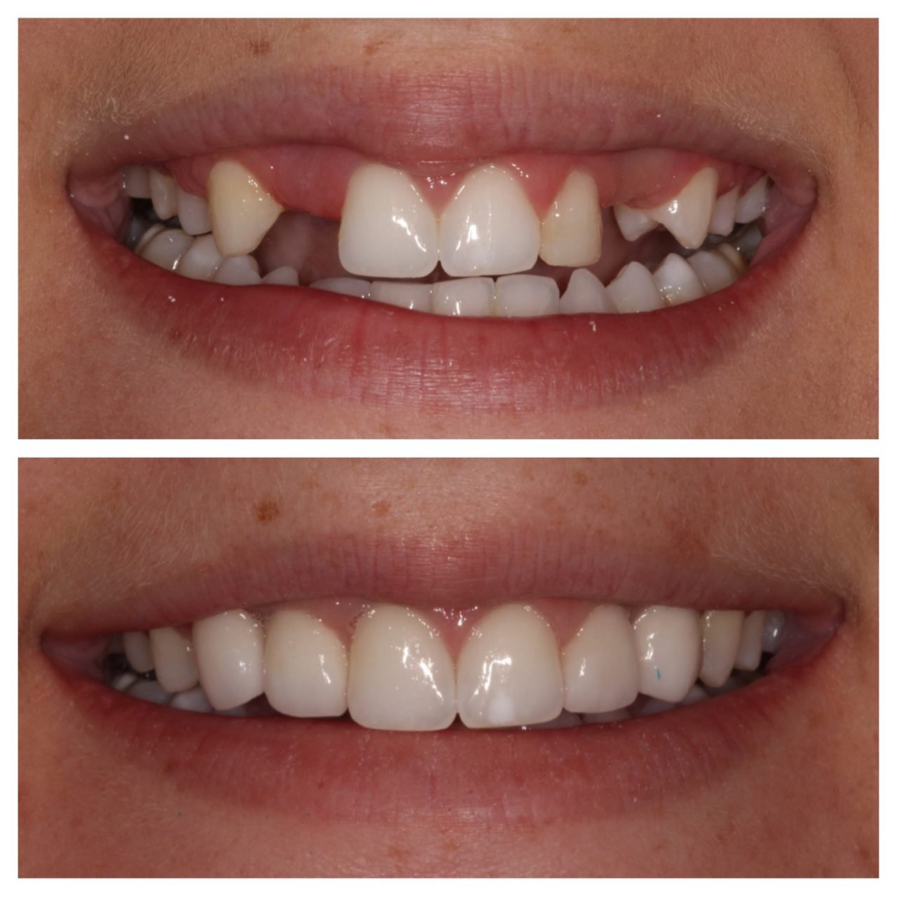 Before & After Smiles | Perfect Smiles at Sierra Smiles