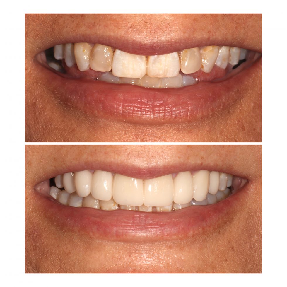Before & After Smiles | Perfect Smiles at Sierra Smiles