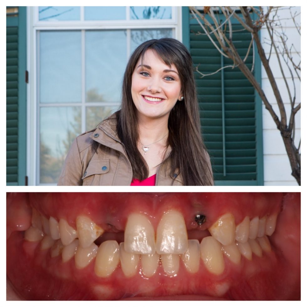 Before & After Smiles | Perfect Smiles at Sierra Smiles