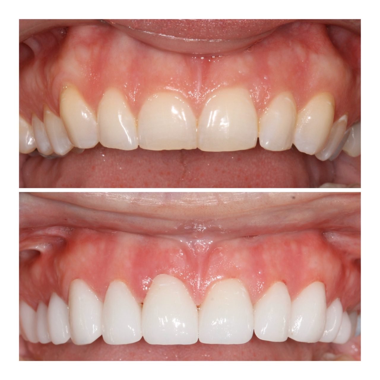 Before & After Smiles | Perfect Smiles at Sierra Smiles