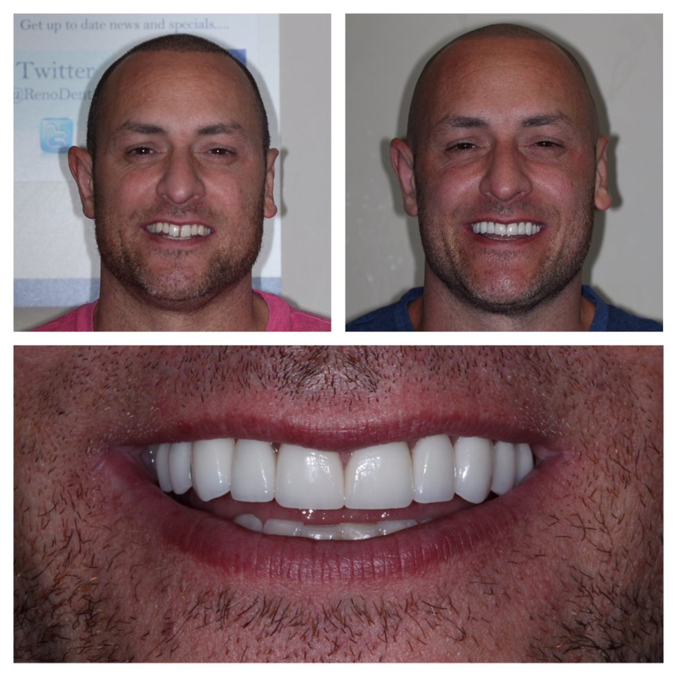 Before & After Smiles | Perfect Smiles at Sierra Smiles
