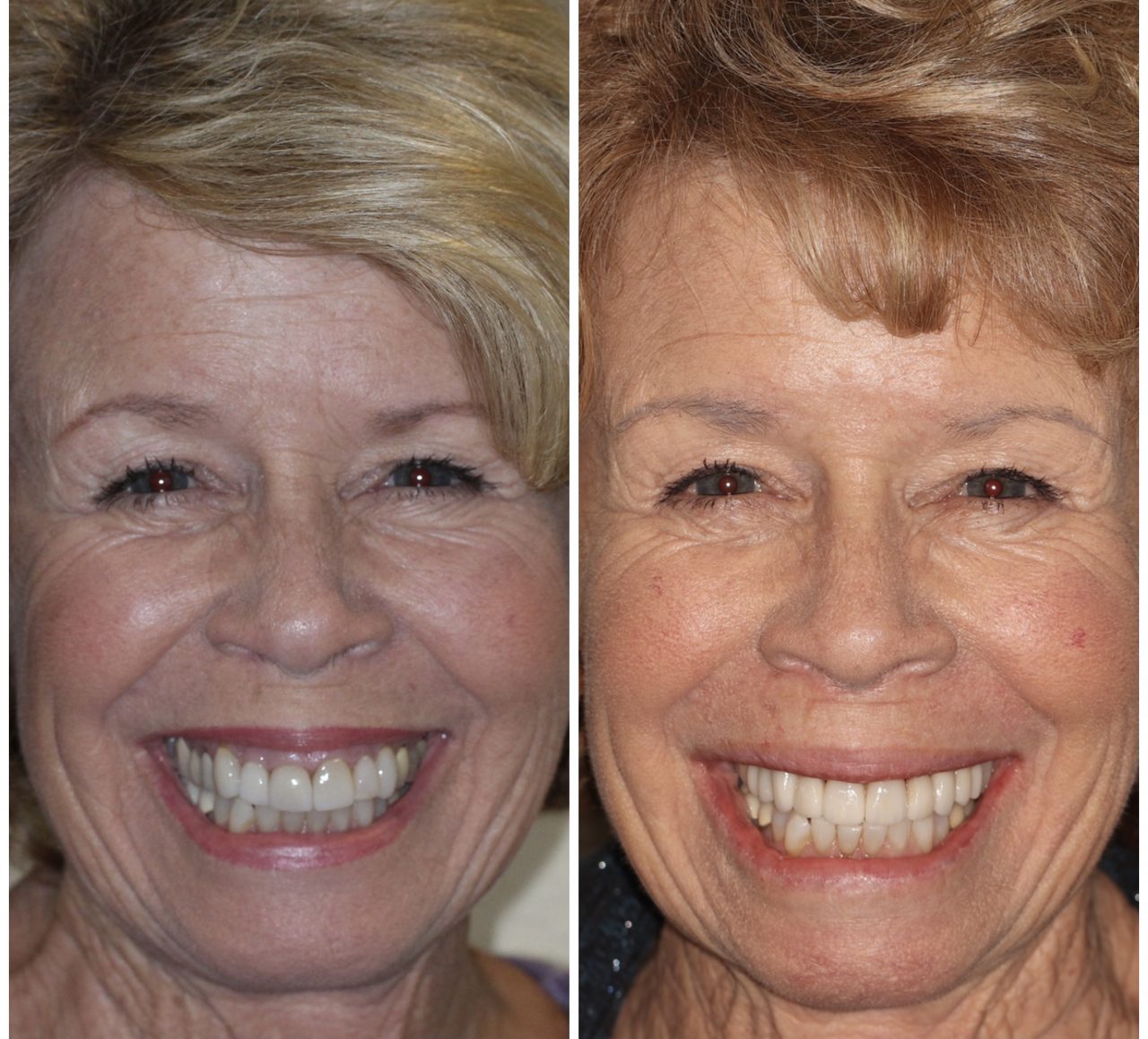 Before & After Smiles | Perfect Smiles at Sierra Smiles